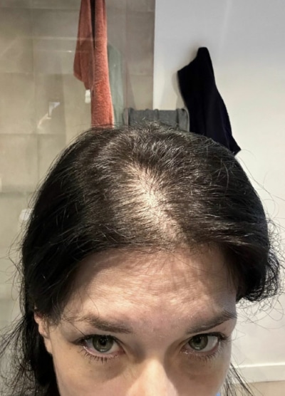 Greffe de Cheveux Paris - Implants Capillaire et Greffe FUE - Centre ...