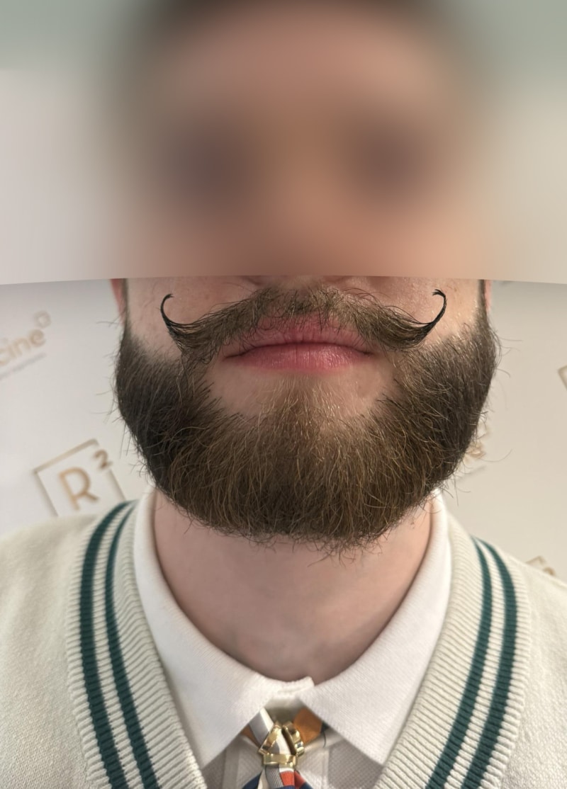 Greffe de barbe et moustache à Paris - Centre Racine Carrée