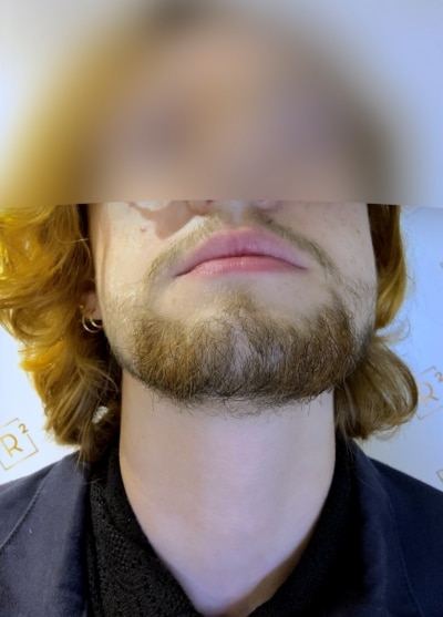 Greffe de barbe et moustache à Paris - Centre Racine Carrée