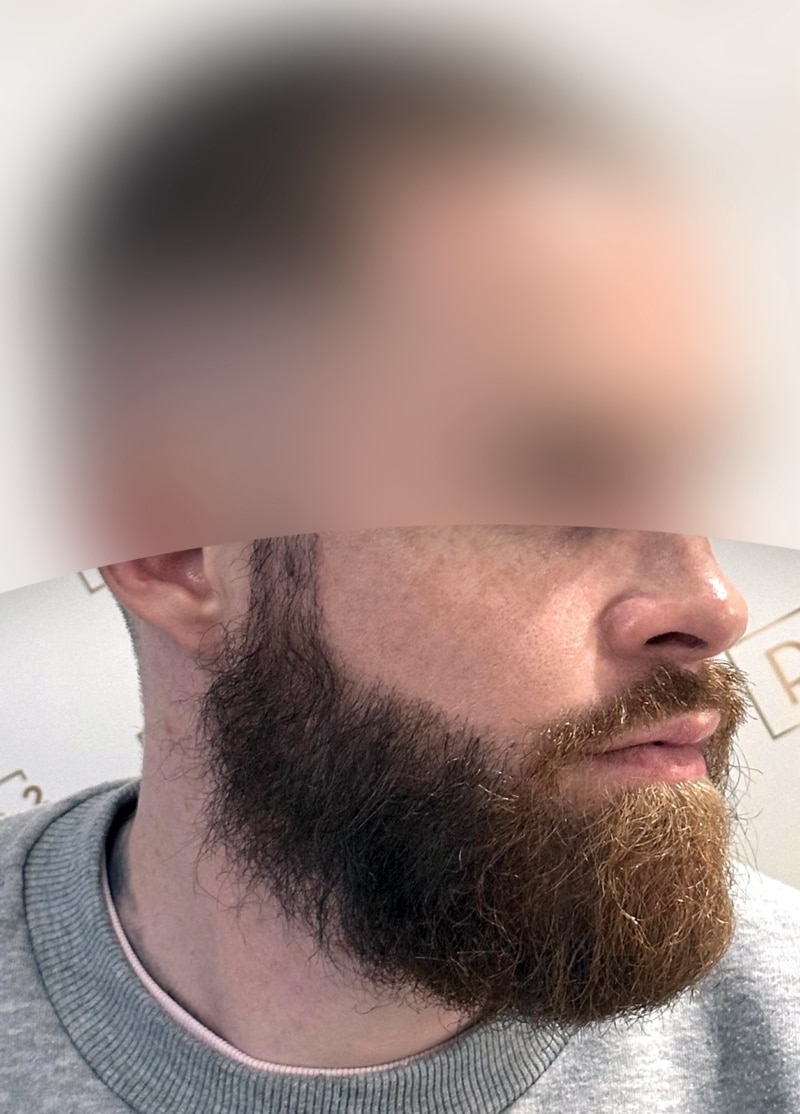 Clinique de greffe de cheveux à Lyon - Centre Racine Carrée