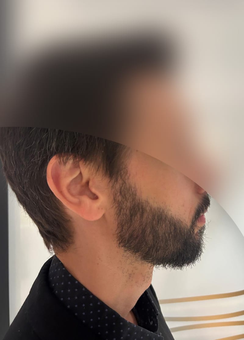 Greffe de barbe et moustache à Paris - Centre Racine Carrée