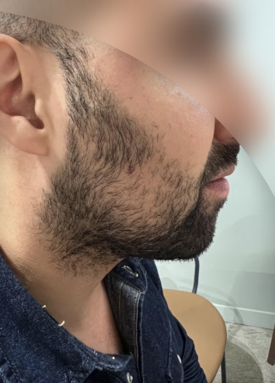 Greffe de barbe et moustache à Paris - Centre Racine Carrée