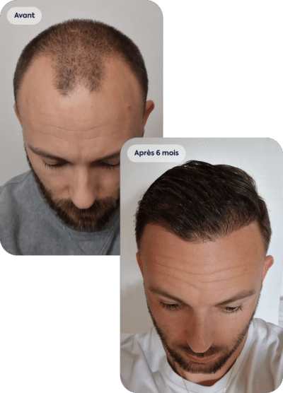 Greffe de Cheveux Paris - Implants Capillaire et Greffe FUE - Centre ...