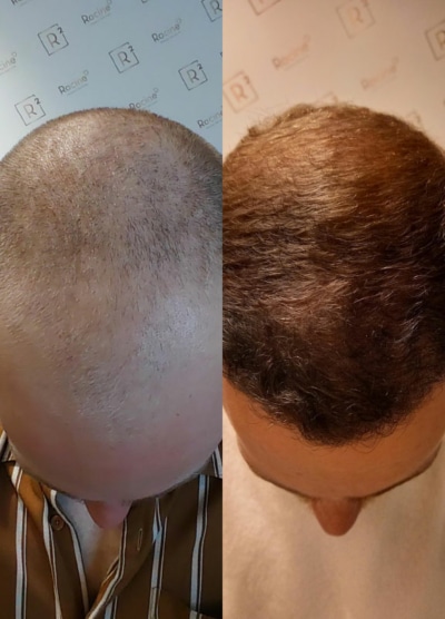 Greffe de Cheveux Paris - Implants Capillaire et Greffe FUE - Centre ...