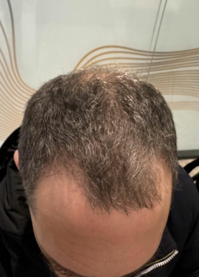 Calvitie homme : causes, symptômes et solutions - Centre Racine Carrée
